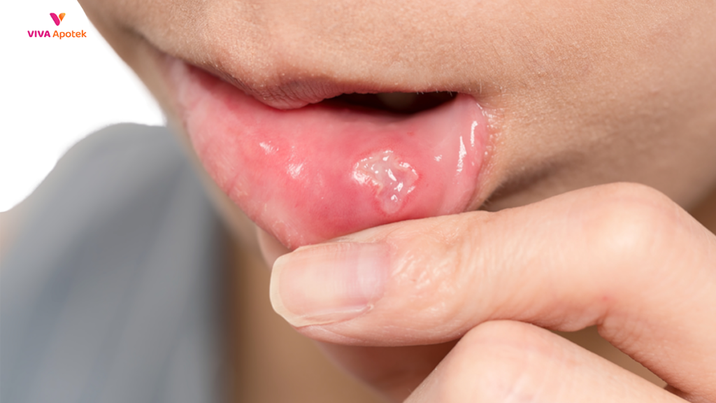 Kenapa Sariawan Perih? Ini Alasan dan Cara Mengatasinya - VIVA Apotek